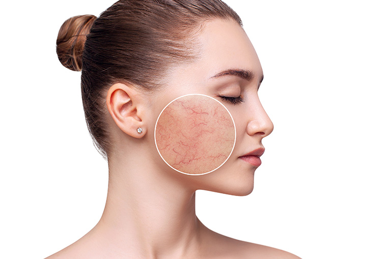 Rozaceea - una dintre afecțiunile des întâlnite ale tenului. Ce factori ...